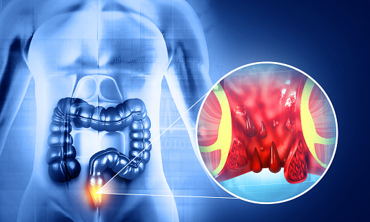 Sentinel Piles: Symptoms & Treatment Options | Haemorrhoid centre